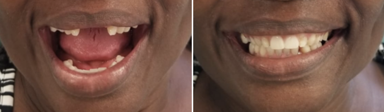 Replace Your Missing Teeth At-Home | ResetSmile