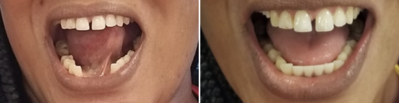 Replace Your Missing Teeth At-Home | ResetSmile