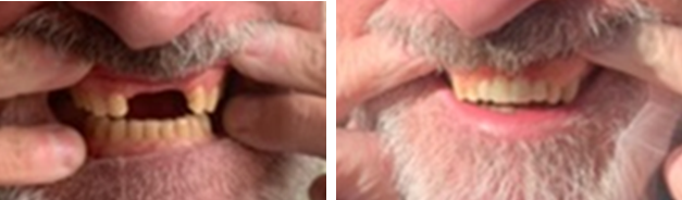 Replace Your Missing Teeth At-Home | ResetSmile