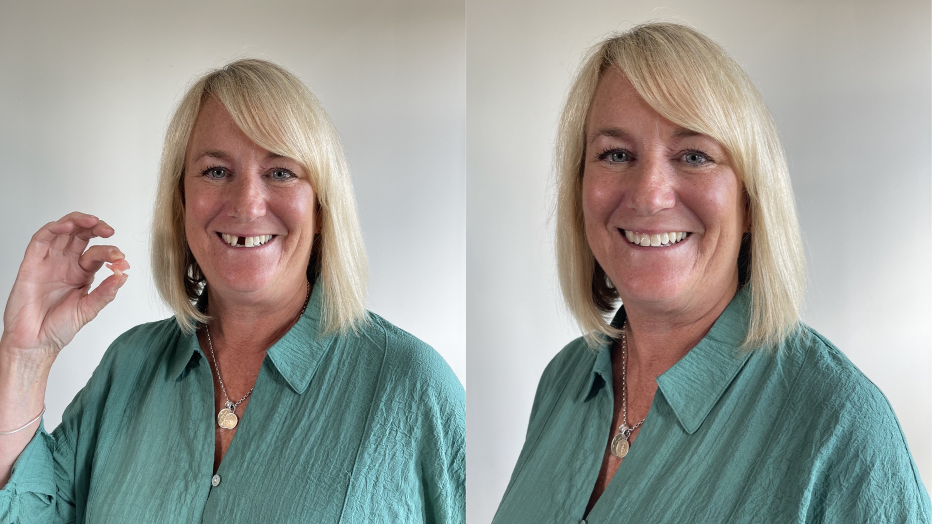 Replace Your Missing Teeth At-Home | ResetSmile